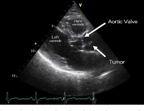 Figure 1 From An Operative Case Of Papillary Fibroelastoma Of The Non