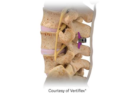 Vertiflex Procedure Coastal Health Specialty Care