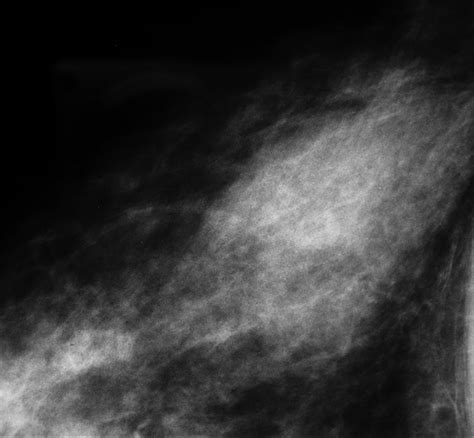 Microcalcifications Around A Collagen Based Breast Biopsy Marker Complication Of Biopsy With A