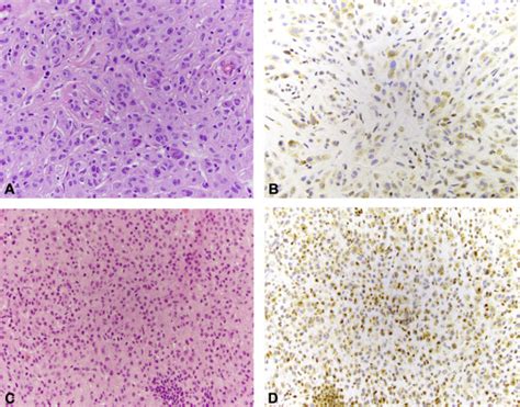 Stages Of Copd Fev1 Define Stages Of Copd Fev1 Define