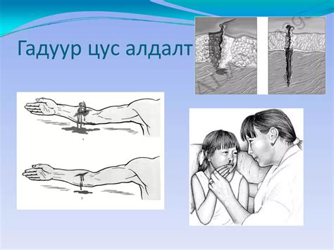 цус алдалтын үед авах арга хэмжээ Ppt