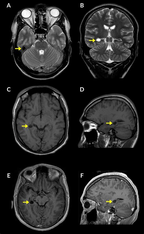Brain Magnetic Resonance Imaging Mri Revealed An Old