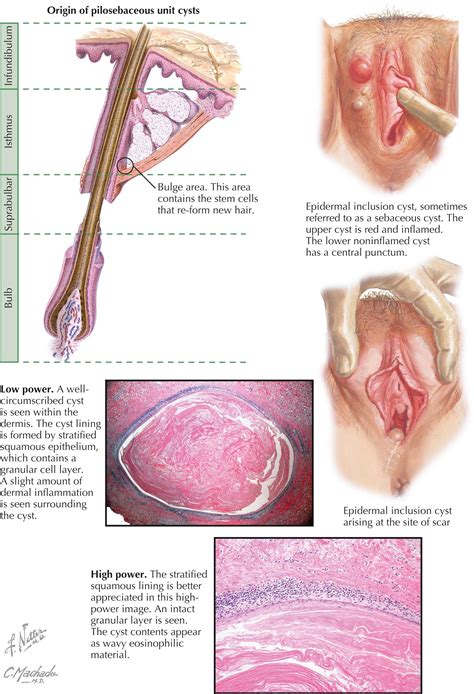 Benign Growths Clinical Tree