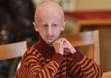 وفاة الشاب سامي أكبر المصابين بالشيخوخة المبكرة عالمياً فيديو الوئام