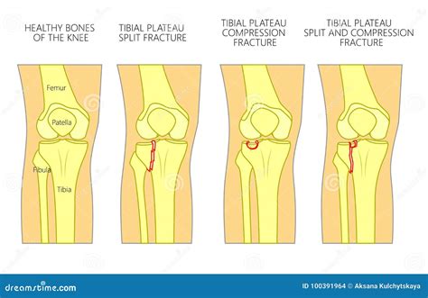 Bone Fracture Tibial Plateau Fracture Stock Vector Illustration Of