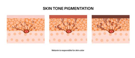 Hyperpigmentation After Chemical Peel Causes Risks Solutions