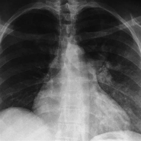 Sinus Rhythm Right Axis Deviation P E Pulmonale An S1t3 Pattern A