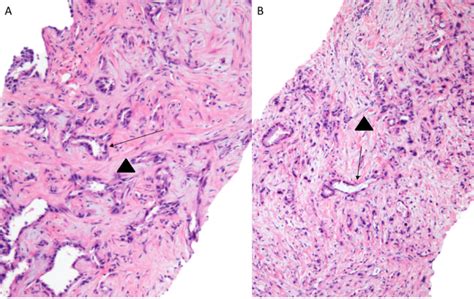 Pathology Pearls Intrahepatic Cholangiocarcinoma Aasld