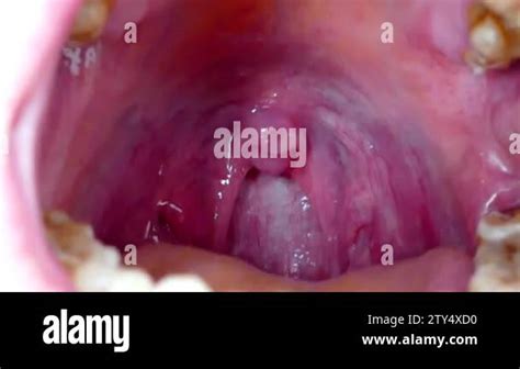 Woman Open Mouth Tonsils Stock Videos And Footage Hd And 4k Video Clips