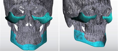 Male Custom Infraorbital Malar And Jawline Implants 3d Design Dr Barry