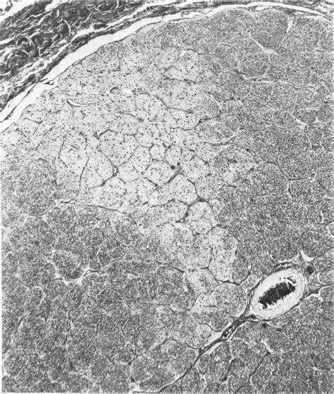 Segmental Atrophy Of Optic Nerve From A Nonirradiated Eye Containing Download Scientific