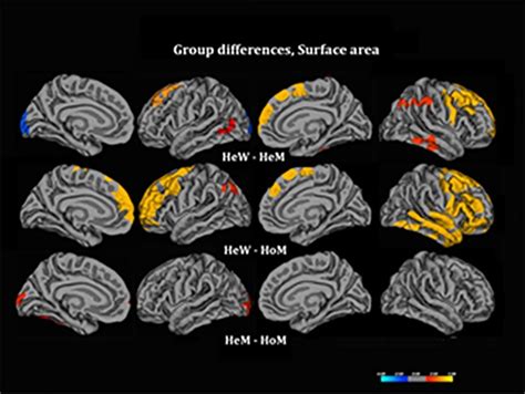 Multimodal Mri Suggests That Male Homosexuality May Be Linked To