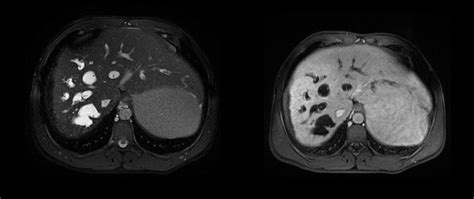 Axial T1 And T2 Weighted Mri Showing Multifocal Large Cystic
