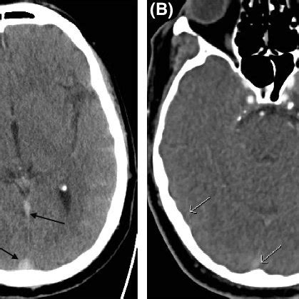 A Noncontrast Enhanced Ct Shows Subarachnoid Hemorrhage In Left