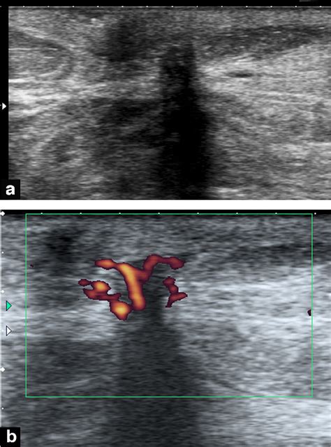 60 Year Old Woman In Whom Screening Routine Mammogram Demonstrated A Download Scientific