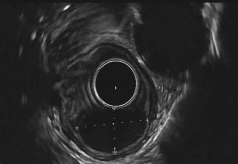Endoscopic Submucosal Dissection Of An Esophageal Granular Cell Tumor Abstract Europe PMC