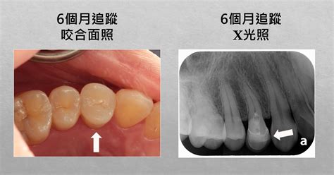 保存粹齒 林俊國醫師 活髓治療與陶瓷嵌體復形實際病例一