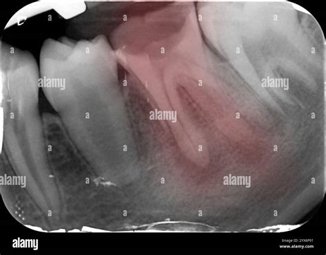 Coloured Periapical X Ray Of A Mandibular Left First Molar Tooth