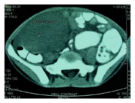 Ct Picture Showing A Well Defined Mass In Right Iliac Fossa Download
