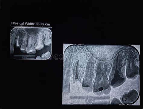 Dental X Ray Image Teeth X Ray Film Stock Image Image Of Dental Hygiene 264732093