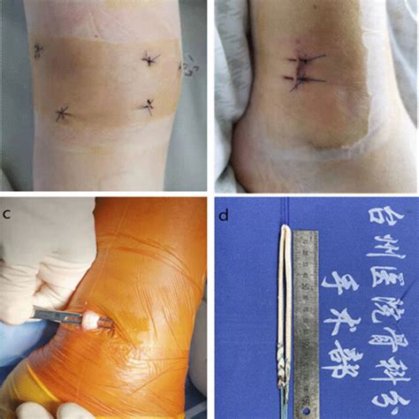 A Five Approaches Distributed Around The Knee B The Incision Made For