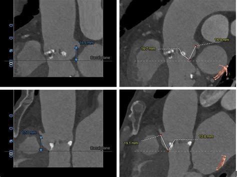 双管齐下｜中国医大一院瓣膜介入团队成功完成经导管主动脉瓣置换术（tavr） 经皮二尖瓣球囊扩张成形术（pbmv）一站式手术 严道医声网