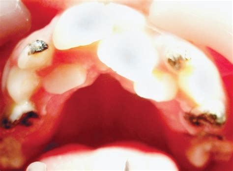 Occlusal View Of The Maxillary Arch Download Scientific Diagram