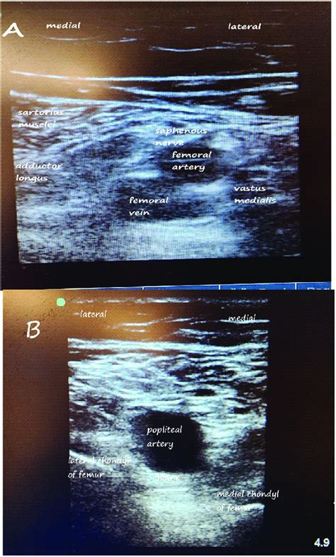 A Adductor Canal Block B I Pack Block Download Scientific Diagram