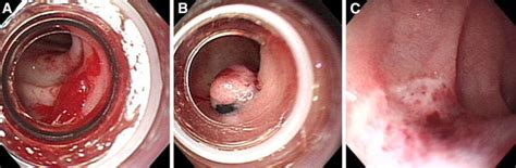 Actively Bleeding Dl In The Post Bulbar Portion Of The Duodenum A Download Scientific