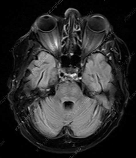 Brain With Metastatic Cancer Post Radiotherapy Mri Scan Stock Image