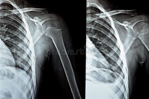 Clavicle Fracture