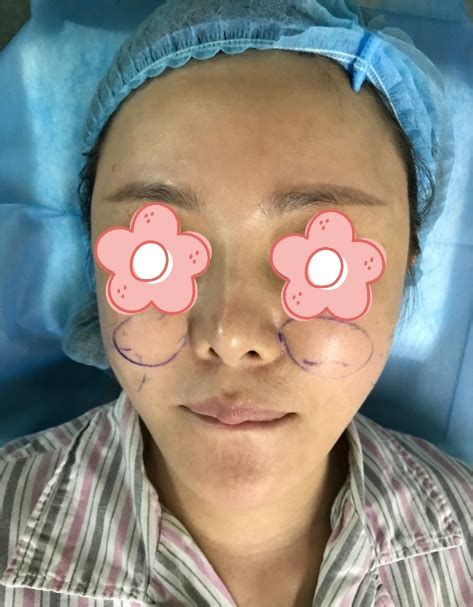 36岁时尚美女4年前打了生长因子，脸上长了“横肉”来修复 知乎