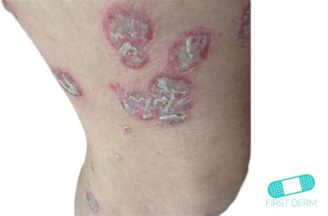 Online Dermatology Psoriasis