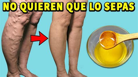Esta Receta Ayuda A Eliminar Las Varices Rápidamente YouTube
