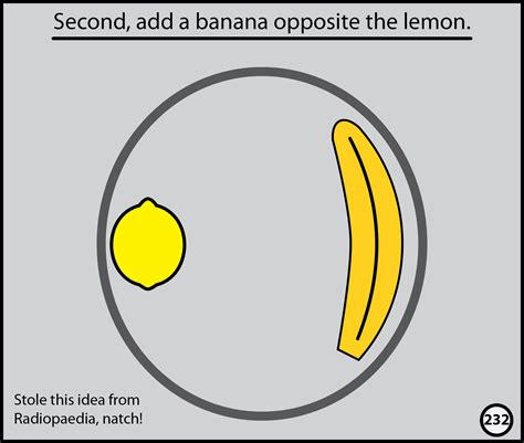 Epidural Hematoma Vs Subdural Hematoma Middle Meningeal Artery