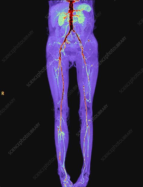 Vascular Disease Ct Scan Stock Image C047 1388 Science Photo Library