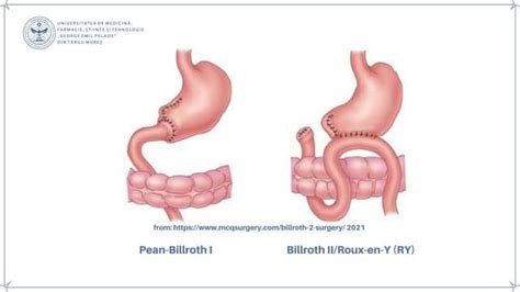 Physiologic Vs Non Physiologicanastomosis After Subtotal Gastrectomies