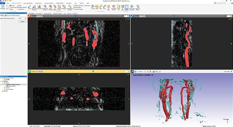 Top Tips To Speed Up Cardiovascular Image Segmentation In Simpleware