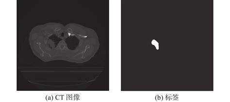 基于pcu Net网络的肺肿瘤分割