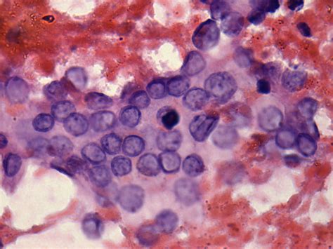 Graves Disease