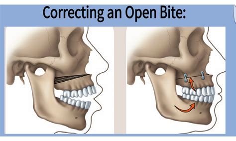 Corrective Jaw Surgery In Tijuana Mexico Angeles Hospital Dental Center