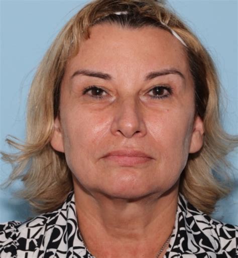 Brow Lift And Blepharoplasty Case 3088 Art Plastic Surgery