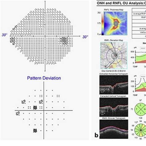 A Humphrey 24 2 Sita Fast Visual Fields Demonstrating A Left Inferior
