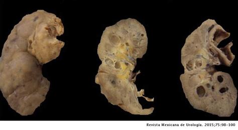 Quiste Renal Complejo Infectado Manejo Laparoscópico Revista
