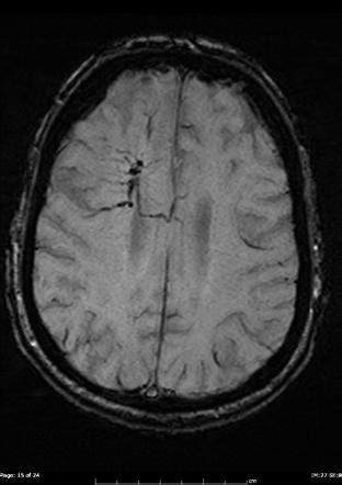 Developmental Venous Anomaly Radiology Case Radiopaedia Org
