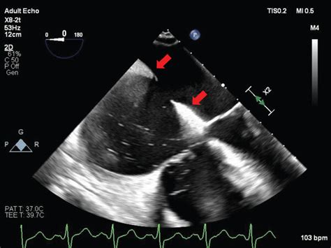 A Tee Mid Esophageal Four Chamber View Confirming Asd With An