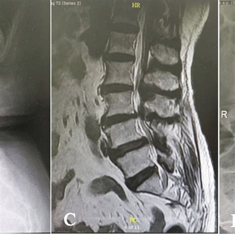 Preoperative Lateral Radiographic And Mri View A E Of A 75 Year Old