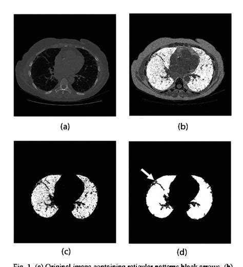 Figure I From Optimizing Lung Volume Segmentation By Texture Classification Semantic Scholar
