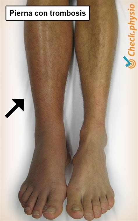 Trombosis De La Pierna Physio Check