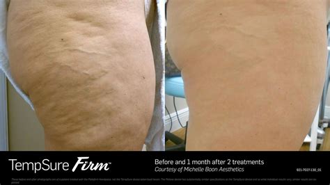 Cellulite Treatment Tempsure Firm Chicago Aesthetics